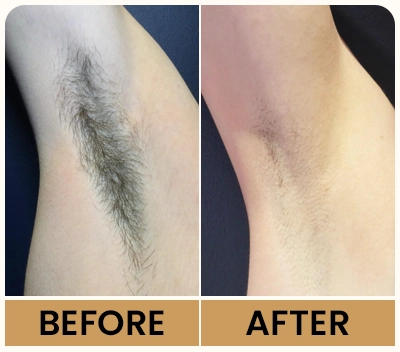Full body laser hair removal
